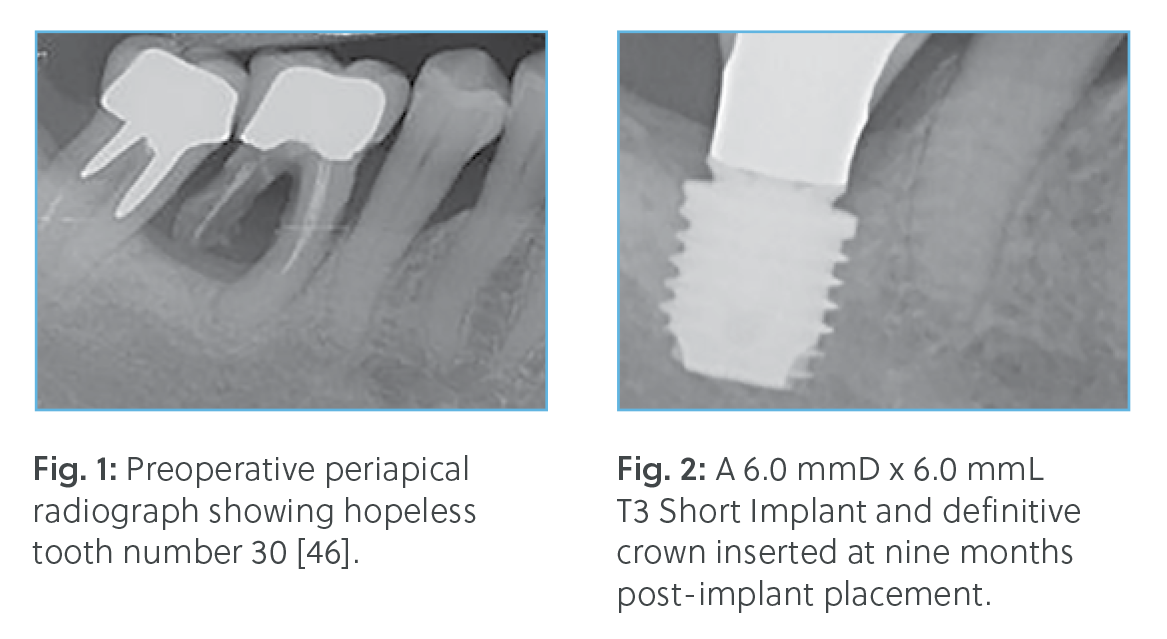 T3 Short Dental Implant | ZimVie Australia & New Zealand